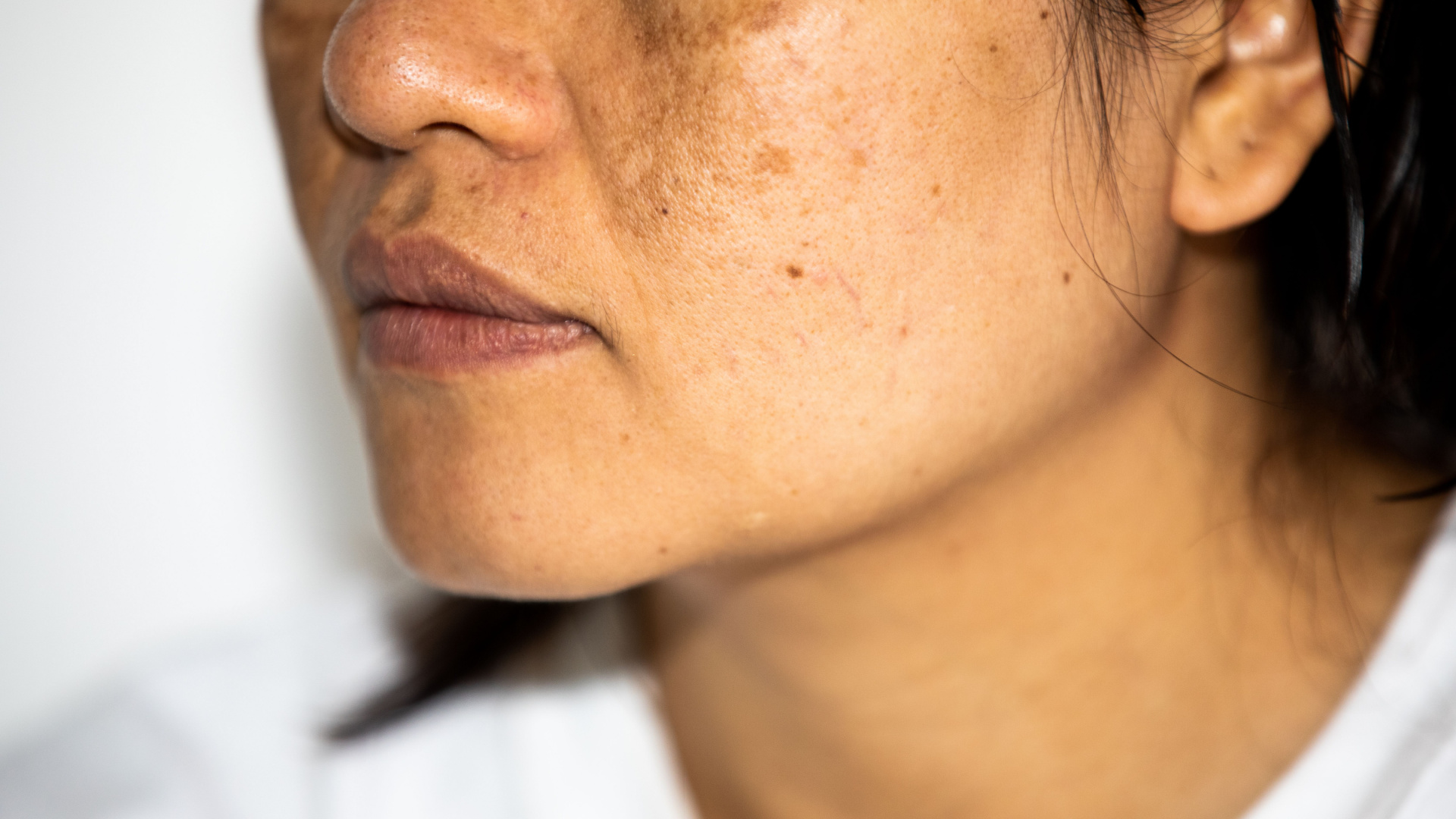 Melasma - Skin Rejuvenation Clinic Skin Rejuvenation Clinic