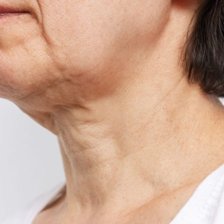 Facial Volume Loss - Skin Rejuvenation Clinic Skin Rejuvenation Clinic