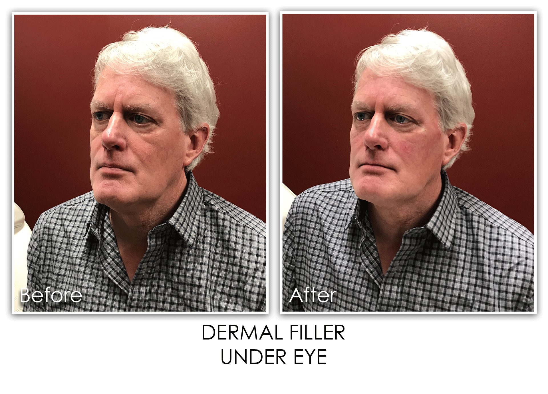 1 DERMAL FILLER UNDER EYE - Skin Rejuvenation Clinic Skin Rejuvenation ...