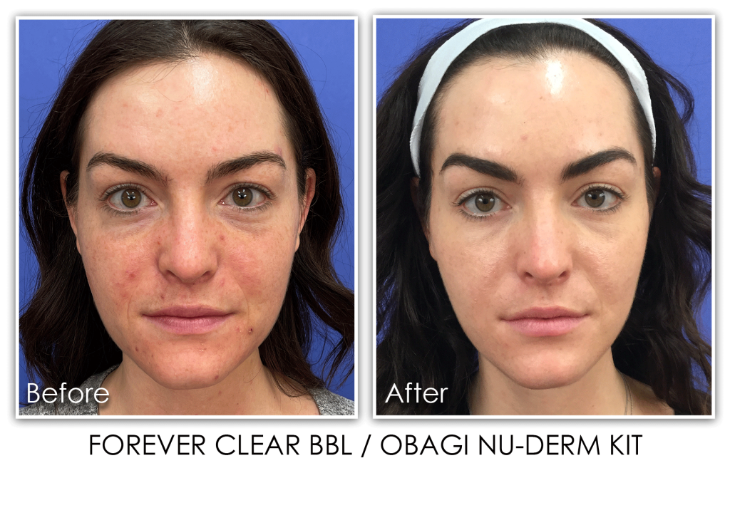 Forever Clear / Acne - Skin Rejuvenation Clinic Skin Rejuvenation Clinic