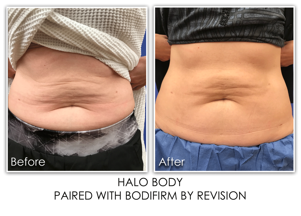 Halo Body | Skin Rejuvenation Clinic Skin Rejuvenation Clinic