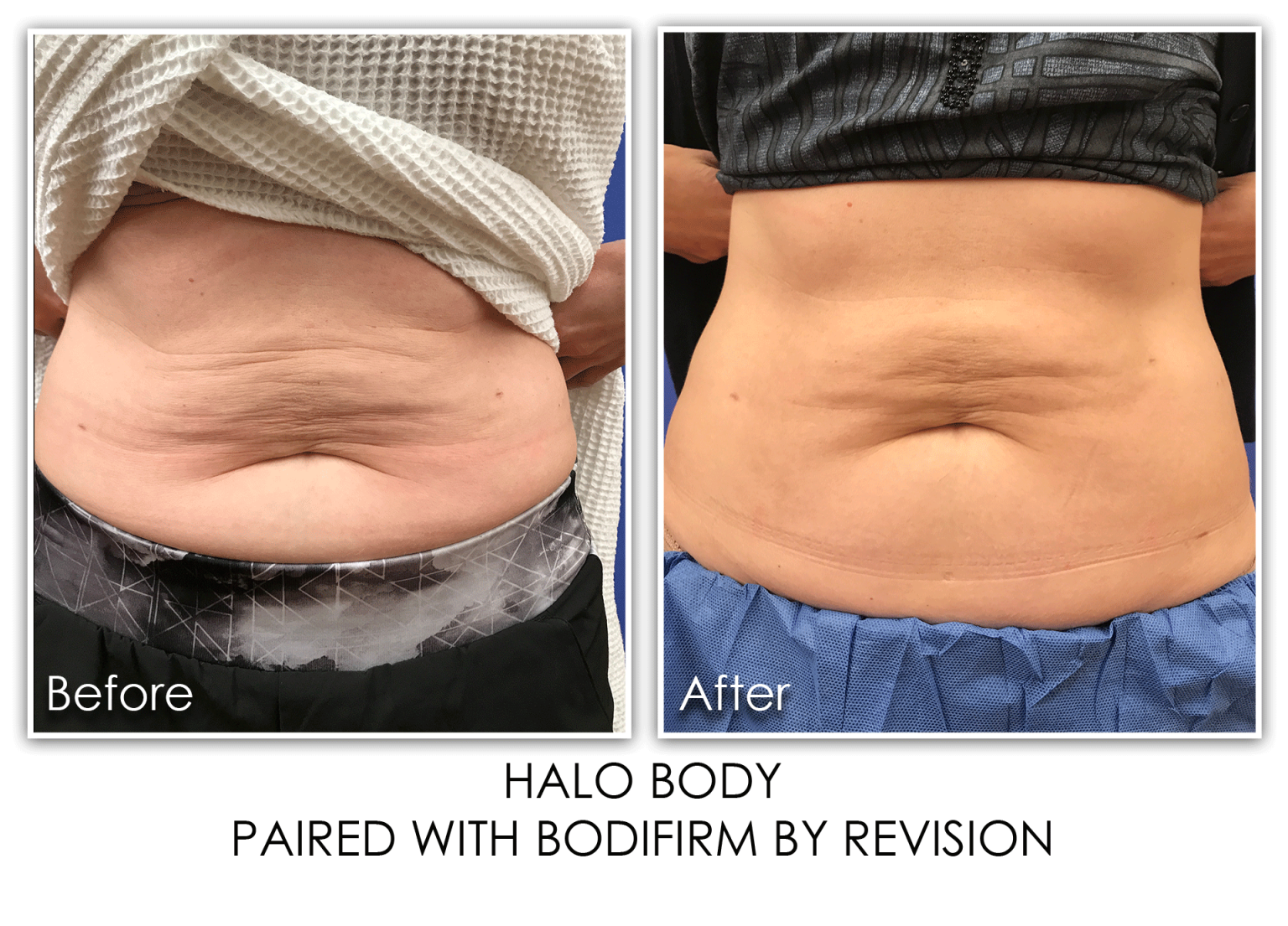 Halo Body | Skin Rejuvenation Clinic Skin Rejuvenation Clinic