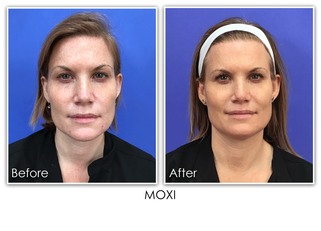 Moxi (Mini Halo) Laser | Skin Rejuvenation Clinic Skin Rejuvenation Clinic