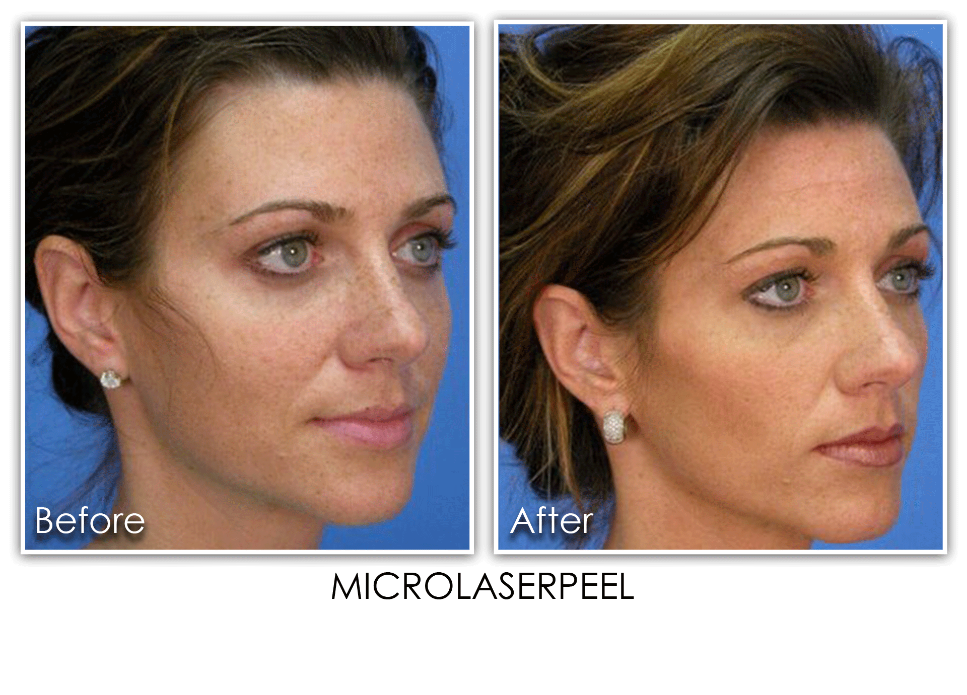 1 MicroLaserPeel - Skin Rejuvenation Clinic Skin Rejuvenation Clinic