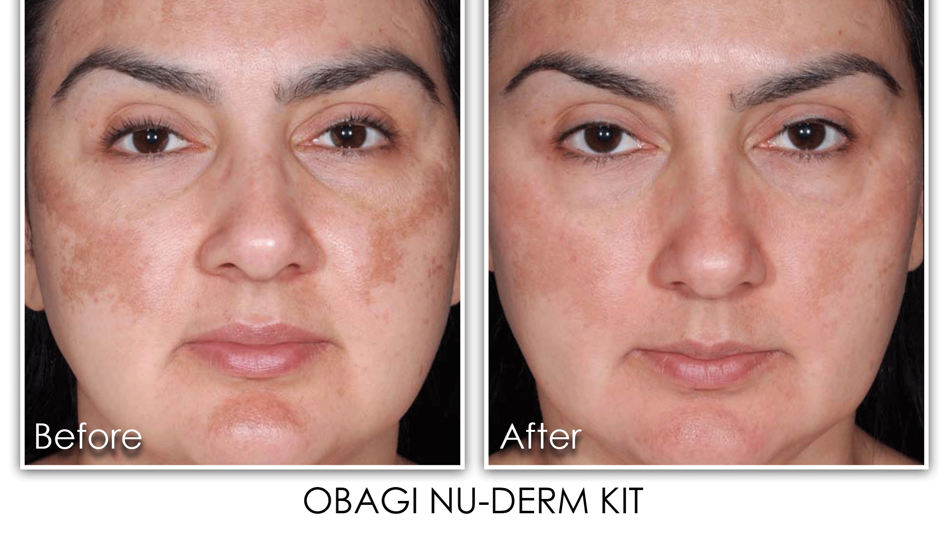 1 Obagi Nu Derm Kit - Skin Rejuvenation Clinic Skin Rejuvenation Clinic
