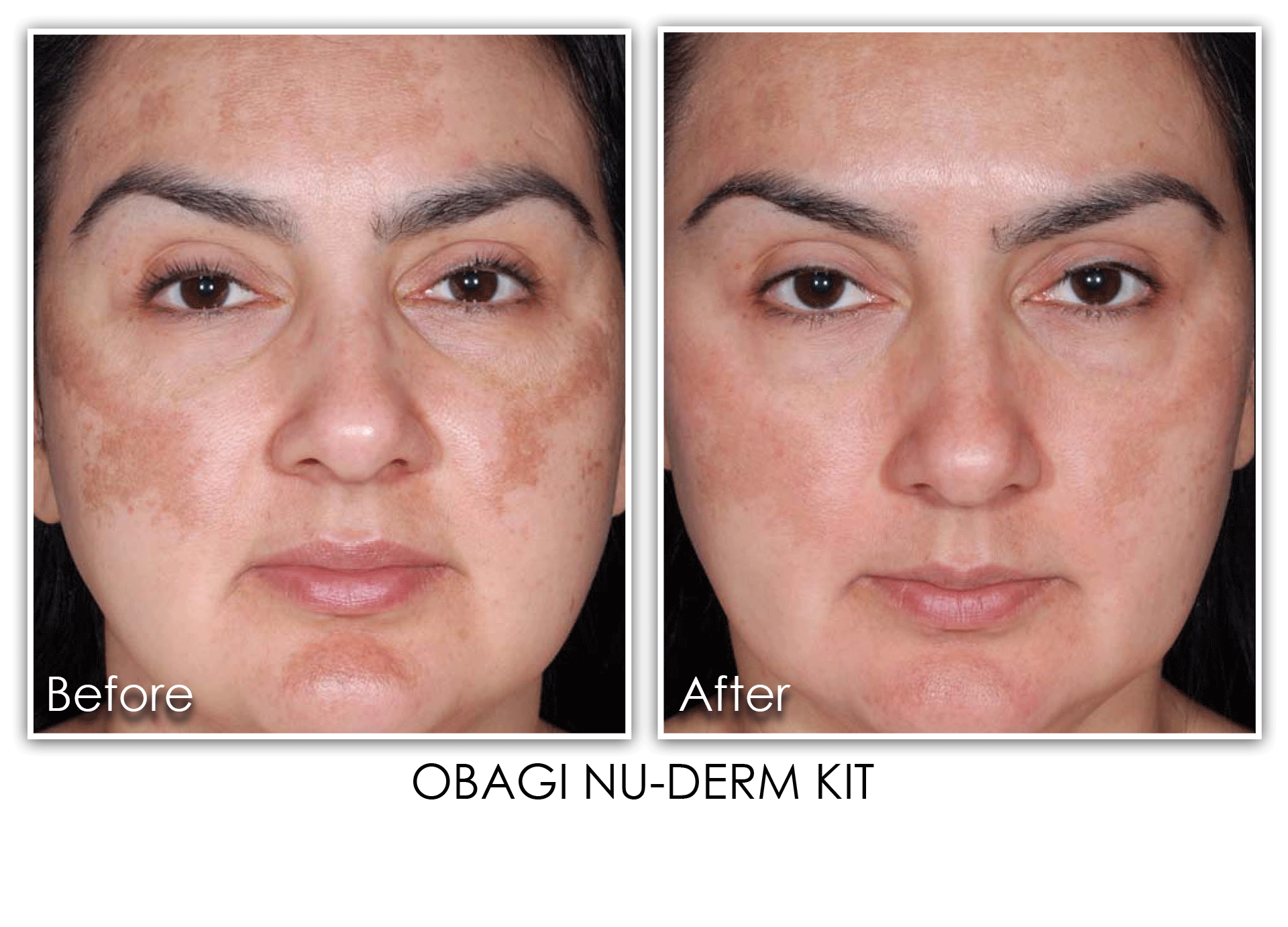 1 Obagi Nu Derm Kit - Skin Rejuvenation Clinic Skin Rejuvenation Clinic