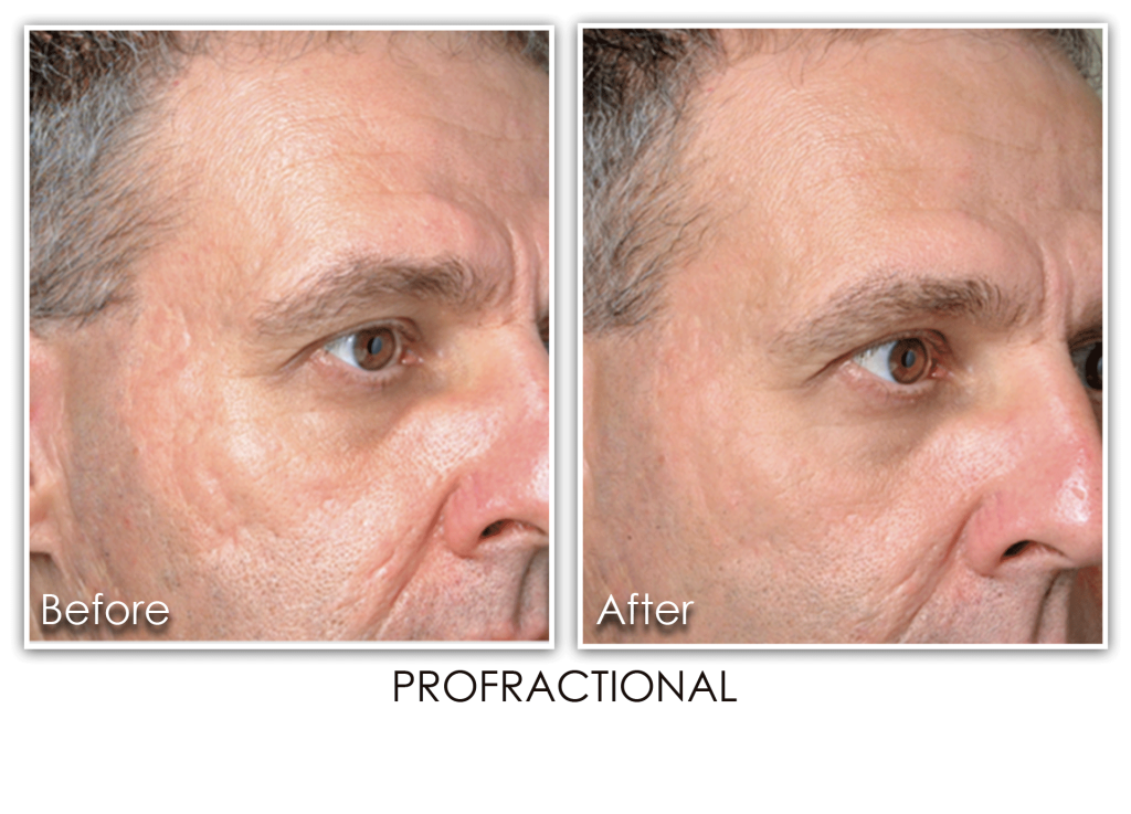 Profractional Laser For Men Archives Skin Rejuvenation Clinic Skin