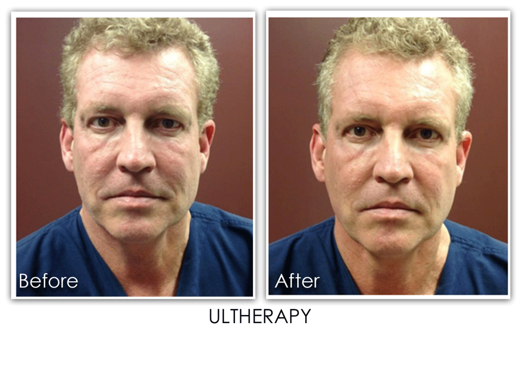 Ultherapy for Men Archives - Skin Rejuvenation Clinic Skin Rejuvenation ...