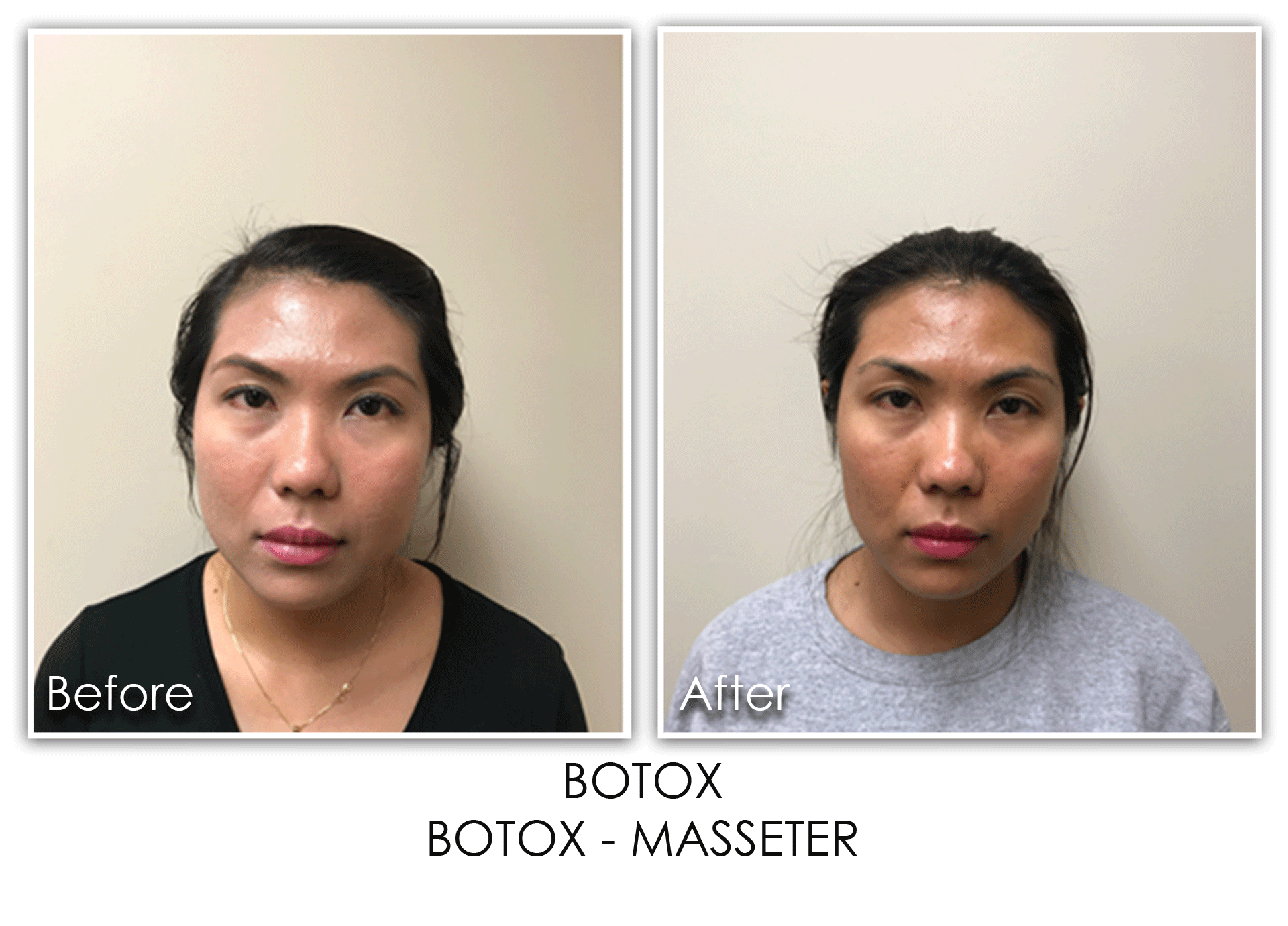 9 Botox - Skin Rejuvenation Clinic Skin Rejuvenation Clinic