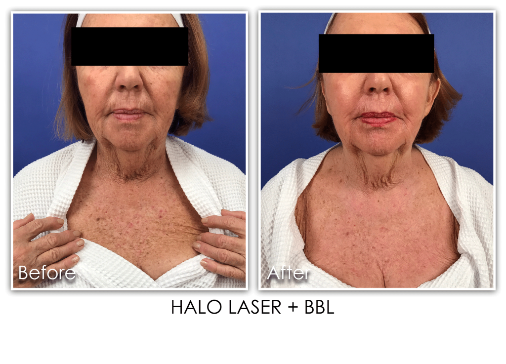 Forever Young BBL Archives - Page 2 of 2 - Skin Rejuvenation Clinic ...