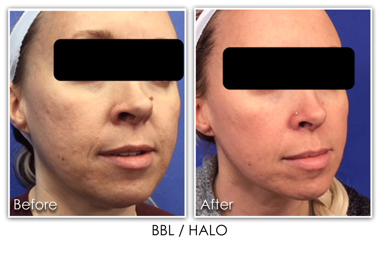 BBL Forever Young | Skin Rejuvenation Clinic Skin Rejuvenation Clinic