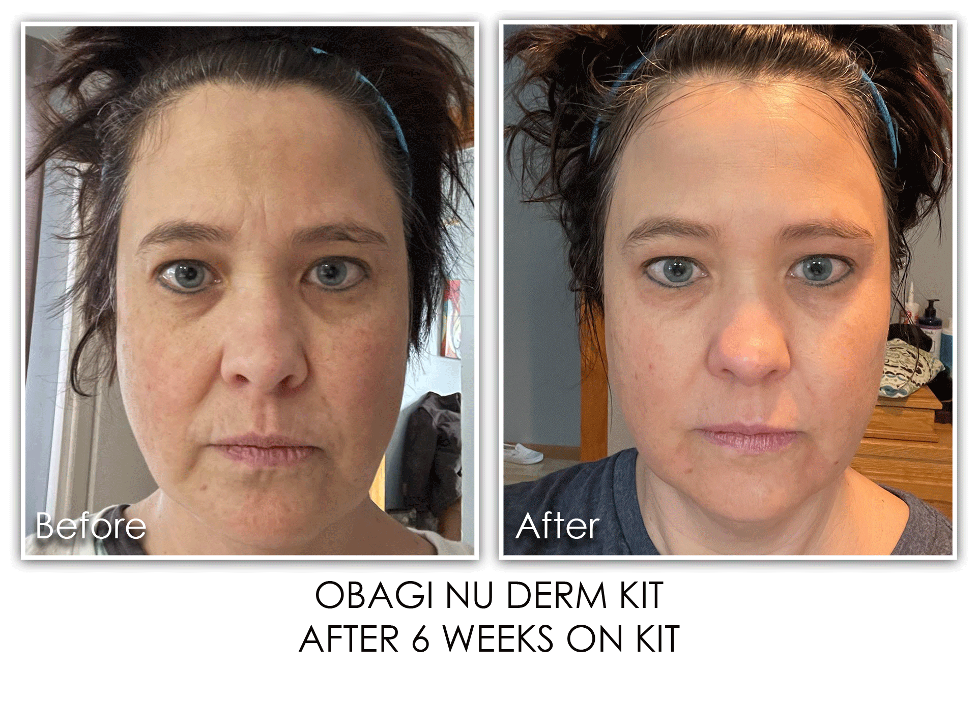 7 Obagi Nu Derm Kit - Skin Rejuvenation Clinic Skin Rejuvenation Clinic
