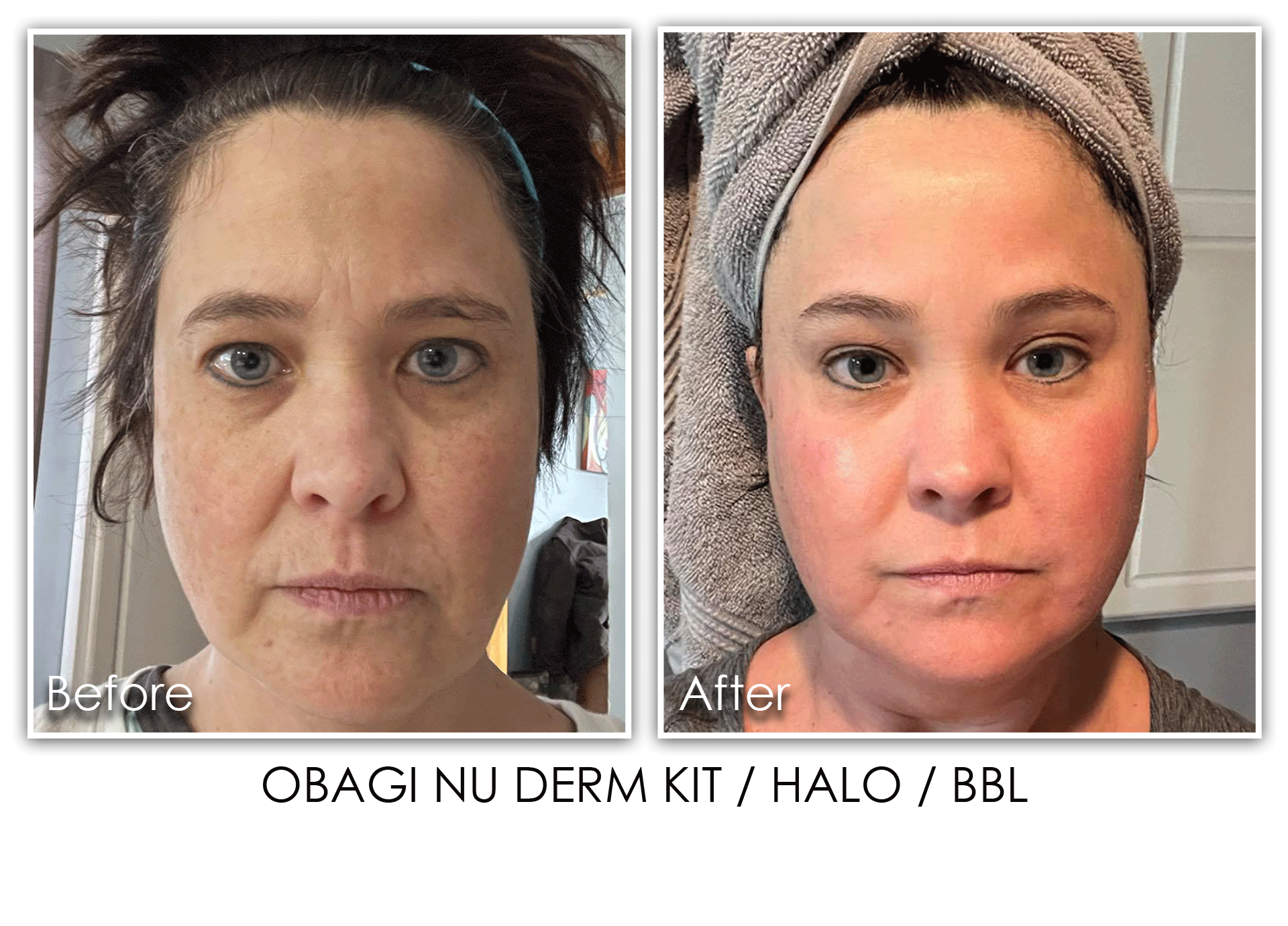 12 BBL HALO NUDERM KIT - Skin Rejuvenation Clinic Skin Rejuvenation Clinic