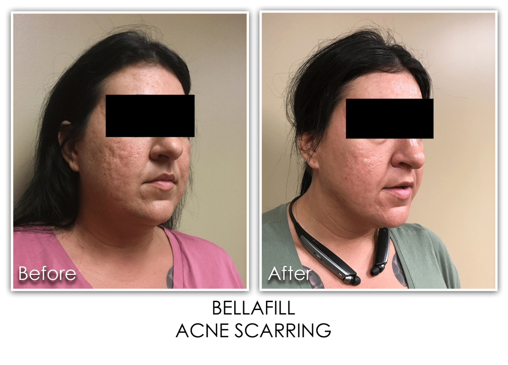 Bellafill Archives - Skin Rejuvenation Clinic Skin Rejuvenation Clinic