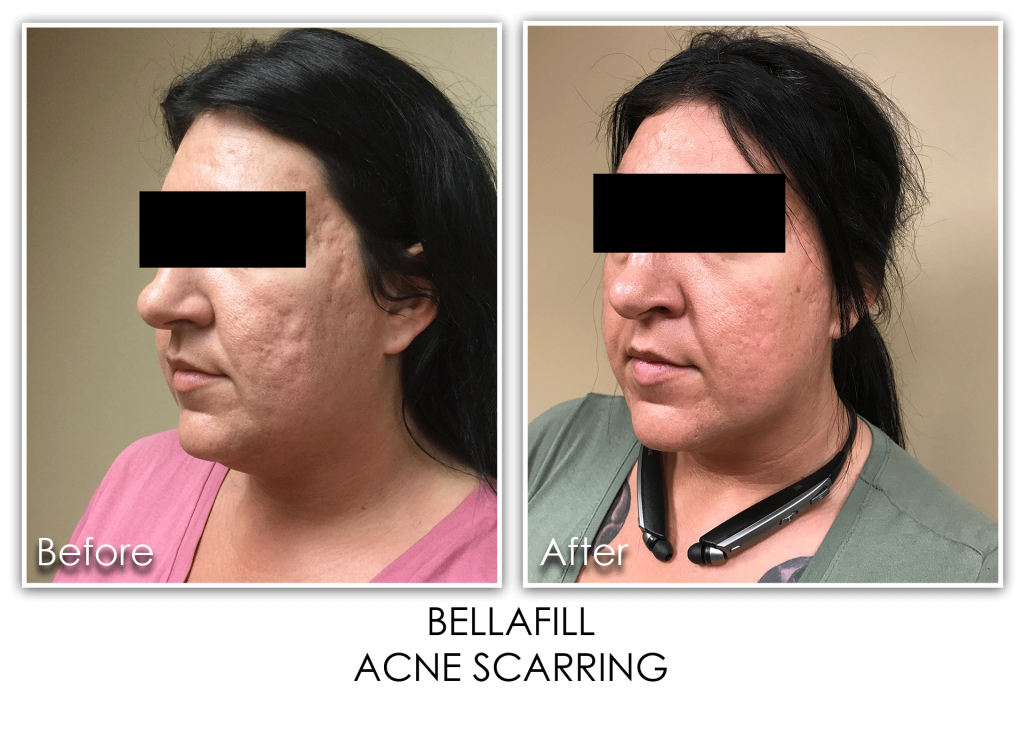Scars Archives - Skin Rejuvenation Clinic Skin Rejuvenation Clinic