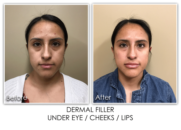 Sculptra - Skin Rejuvenation Clinic Skin Rejuvenation Clinic