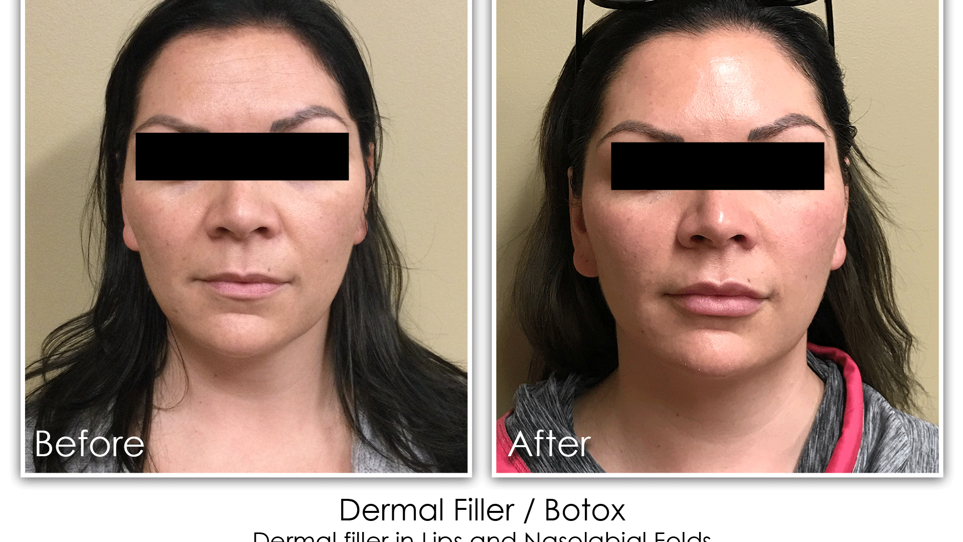 44 Dermal Filler Lips NLF Botox - Skin Rejuvenation Clinic Skin ...