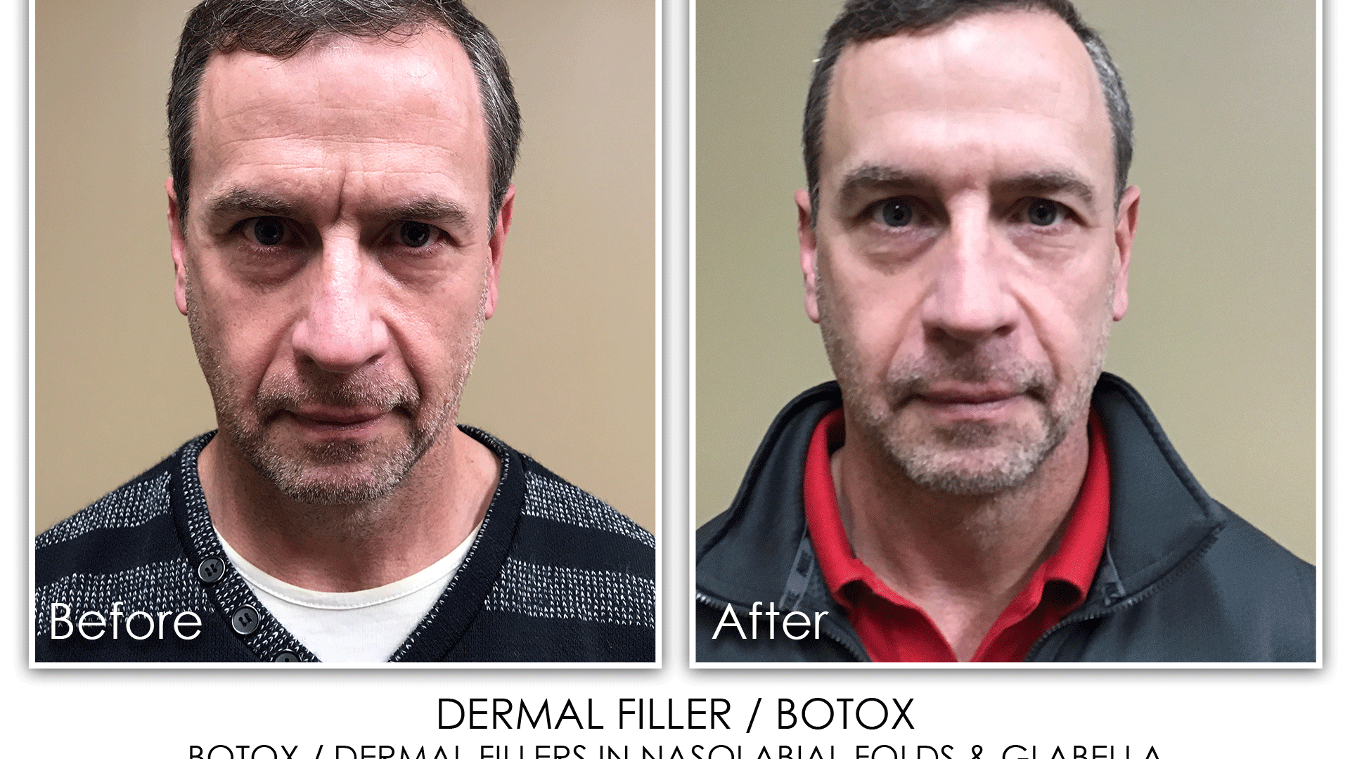 45 BOTOX / DERMAL FILLERS NASOLABIAL FOLDS GLABELLA - Skin Rejuvenation ...