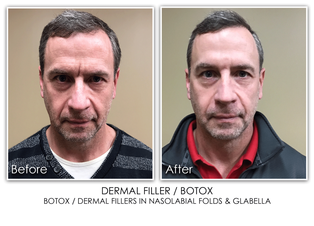 Botox and Dysport for Men Archives - Skin Rejuvenation Clinic Skin ...