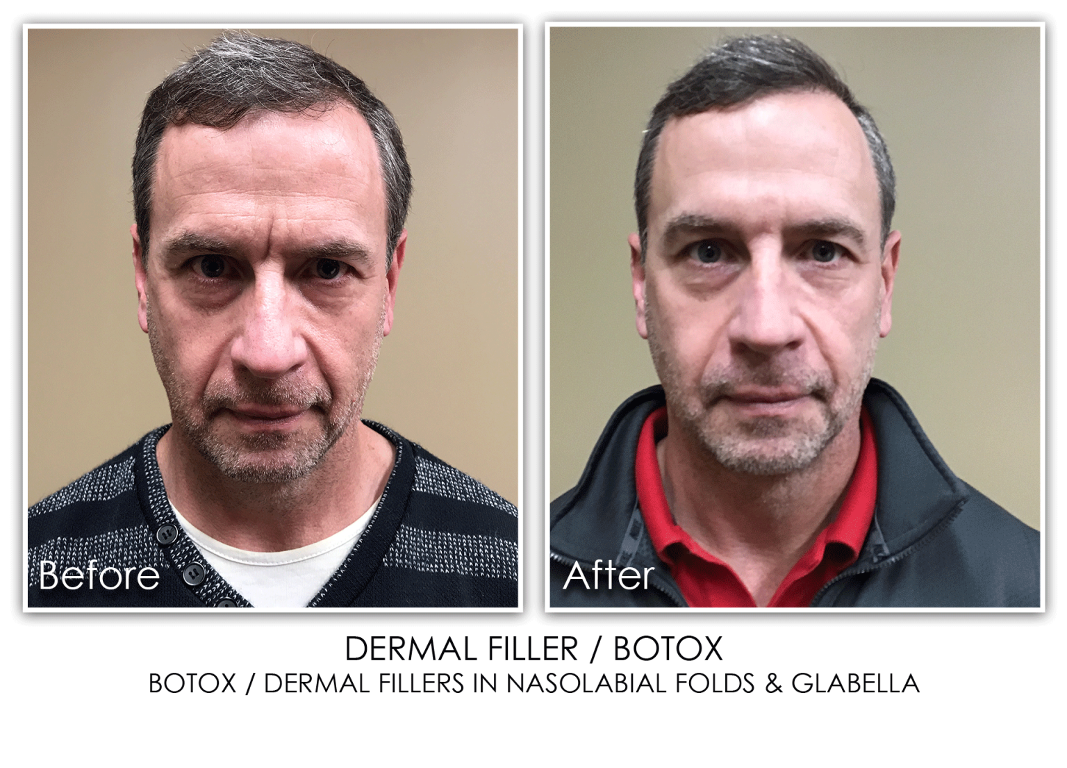 Dermal Fillers - Skin Rejuvenation Clinic Skin Rejuvenation Clinic