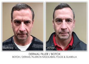 Botox | Skin Rejuvenation Clinic Skin Rejuvenation Clinic