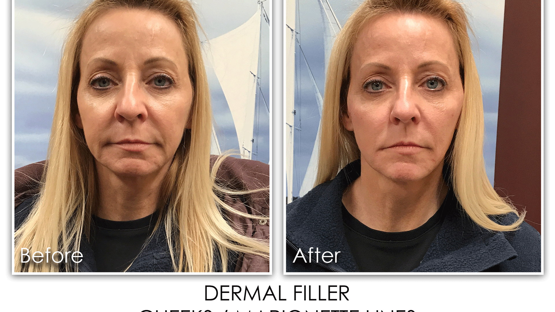 18 DERMAL FILLER CHEEKS MARIONETTE LINES - Skin Rejuvenation Clinic ...