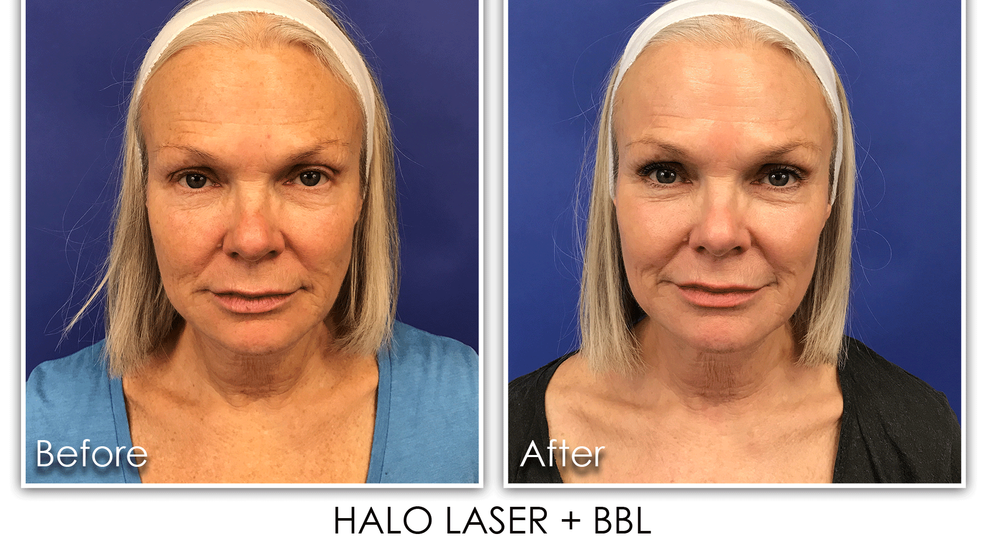 18 HALO / BBL - Skin Rejuvenation Clinic Skin Rejuvenation Clinic