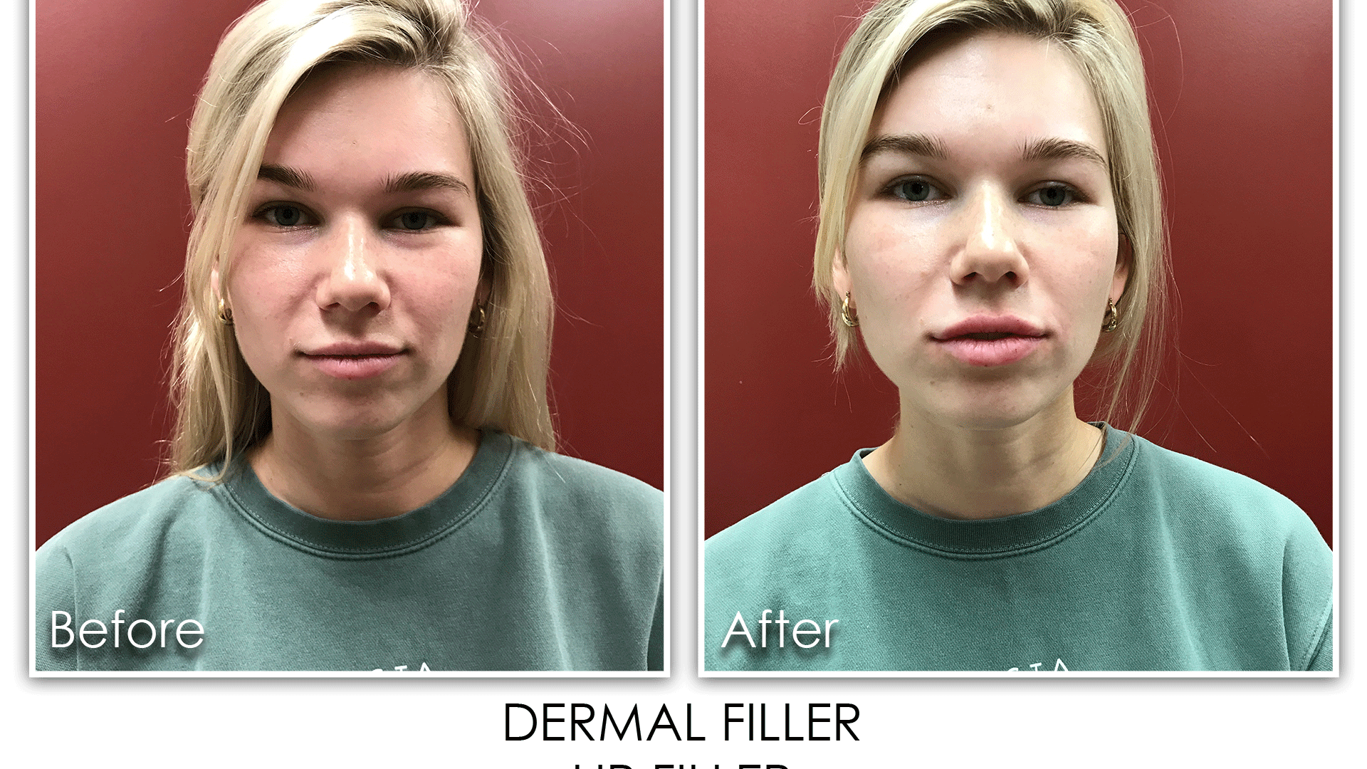 19 DERMAL FILLER LIP FILLER - Skin Rejuvenation Clinic Skin ...