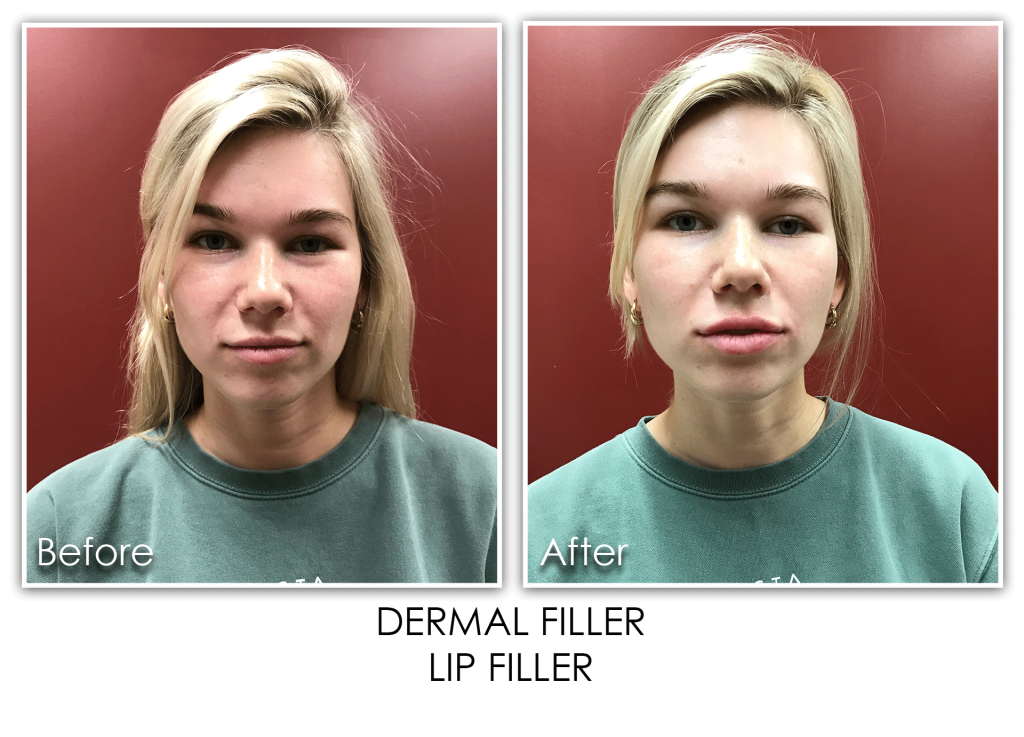 Lip Fillers - Skin Rejuvenation Clinic Skin Rejuvenation Clinic