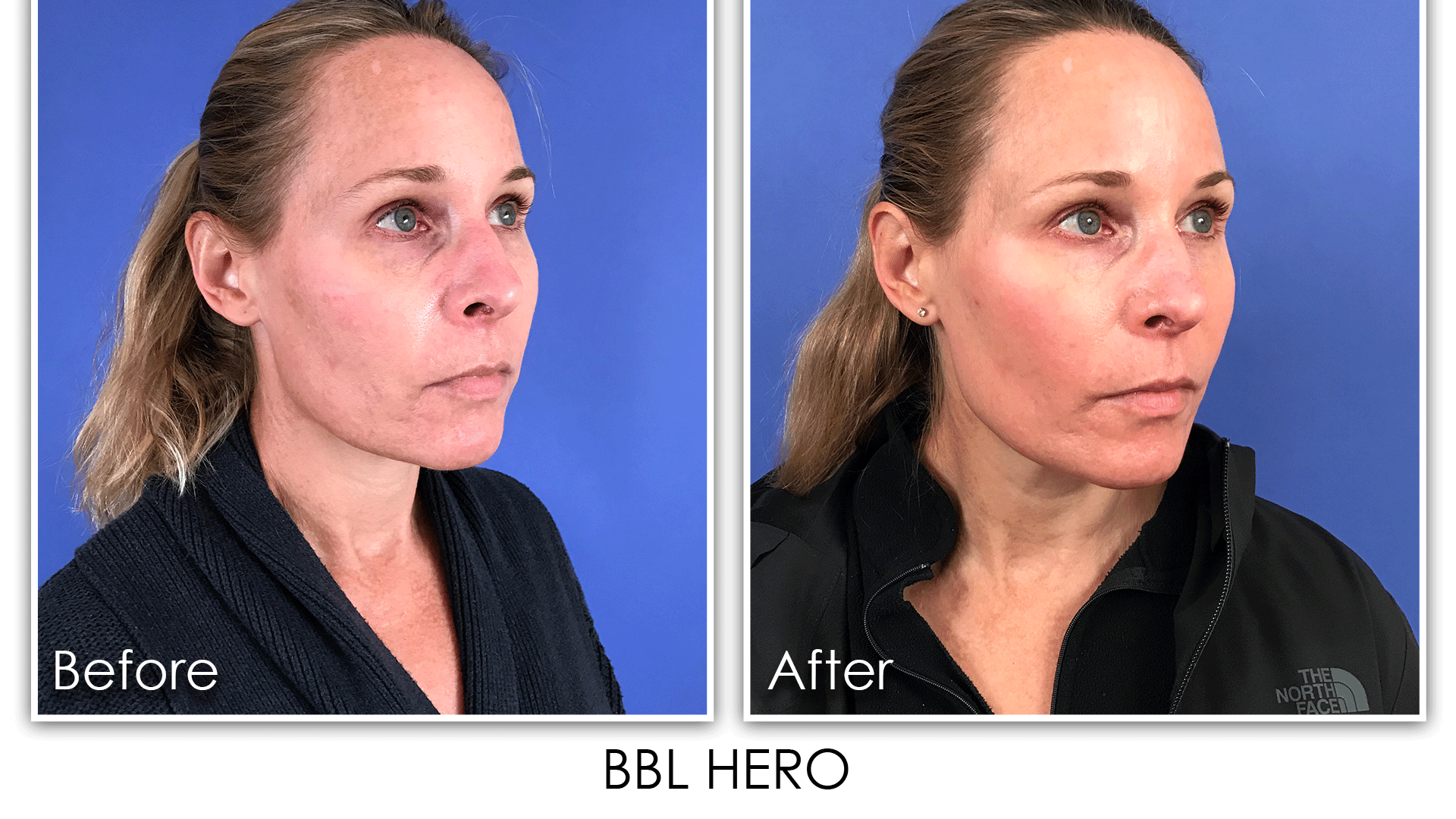 2 BBL HERO - Skin Rejuvenation Clinic Skin Rejuvenation Clinic