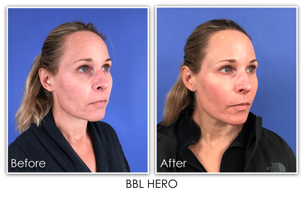 BBL Hero | BBL | Skin Rejuvenation Clinic Skin Rejuvenation Clinic