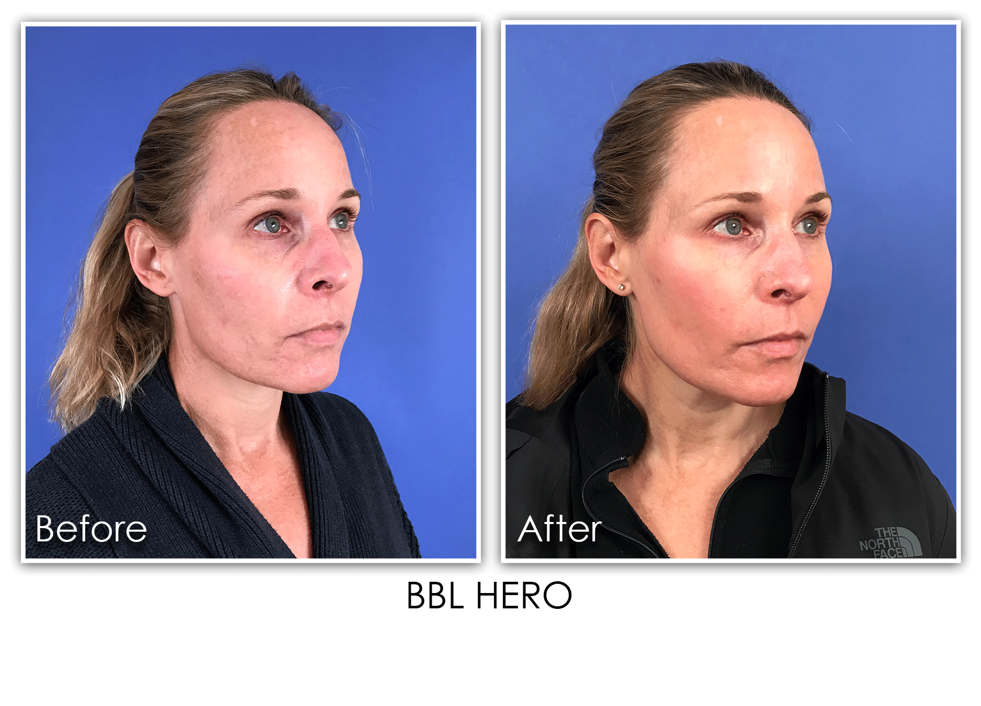 2 BBL HERO - Skin Rejuvenation Clinic Skin Rejuvenation Clinic