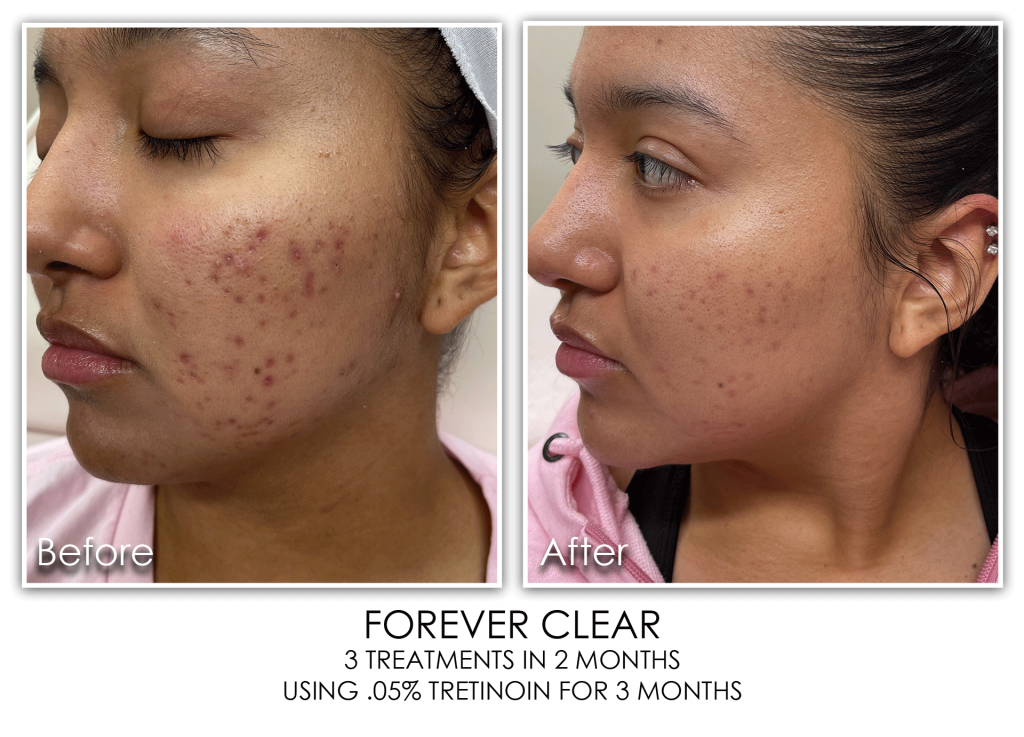 Forever Clear / Acne - Skin Rejuvenation Clinic Skin Rejuvenation Clinic