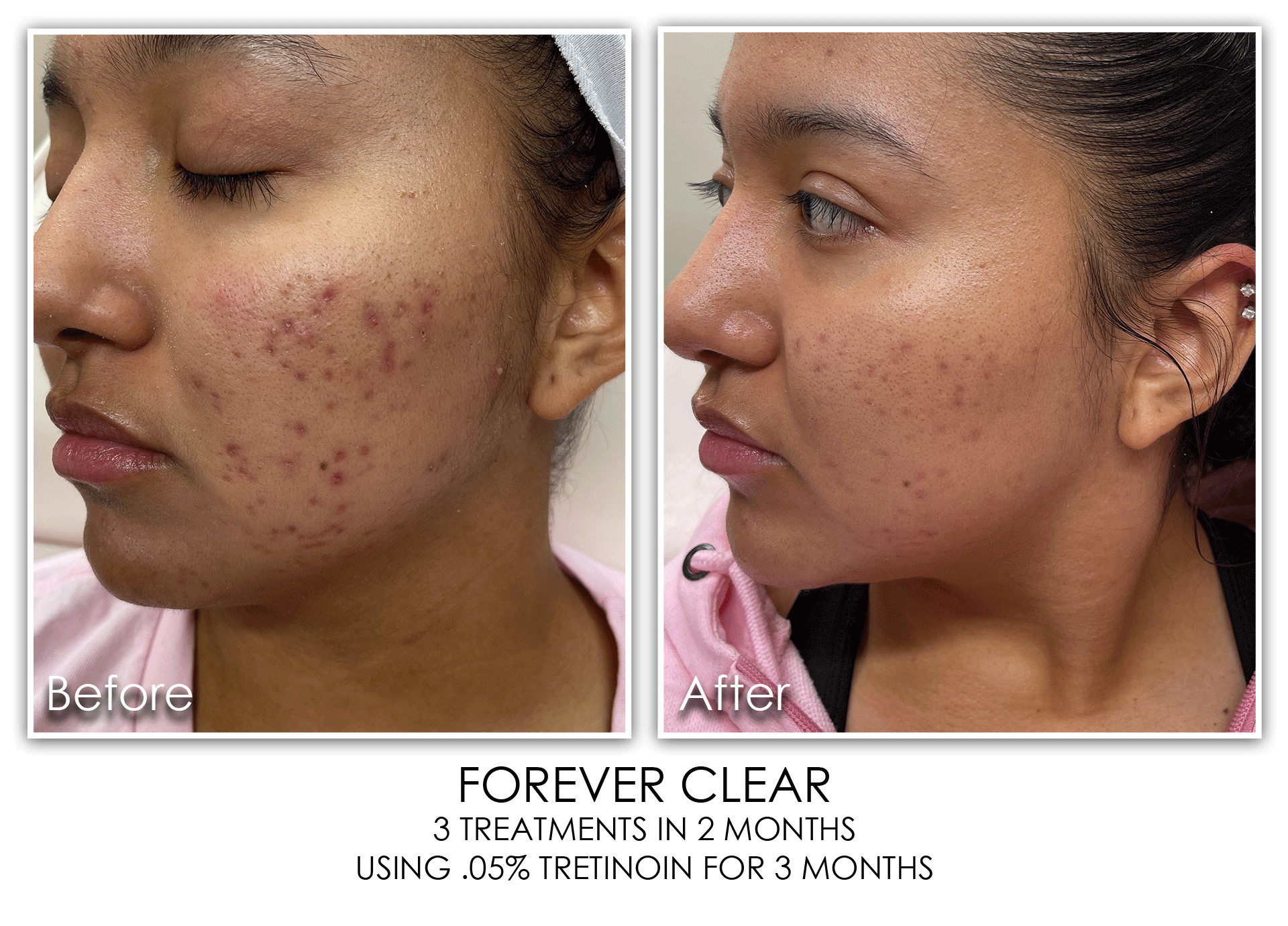 Tretinoin Before And After Scar