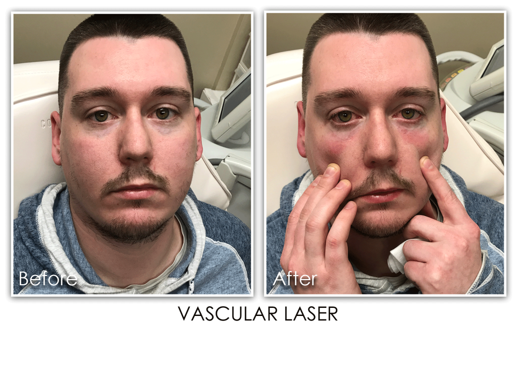 Laser and Light for Men Archives | Skin Rejuvenation Clinic Skin ...