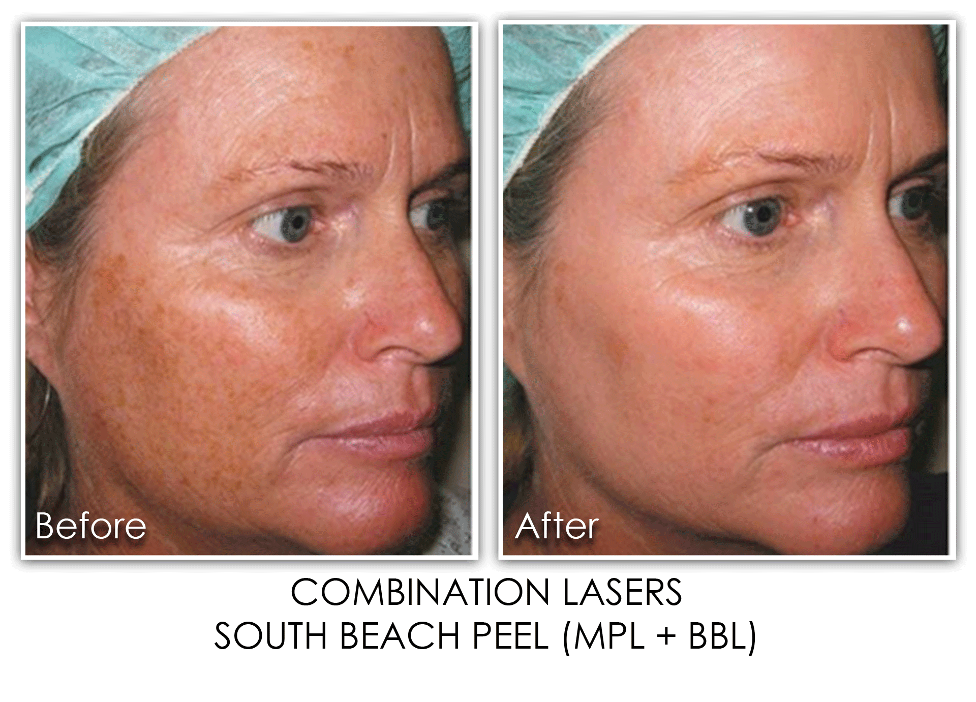 3 COMBINATION LASER - Skin Rejuvenation Clinic Skin Rejuvenation Clinic