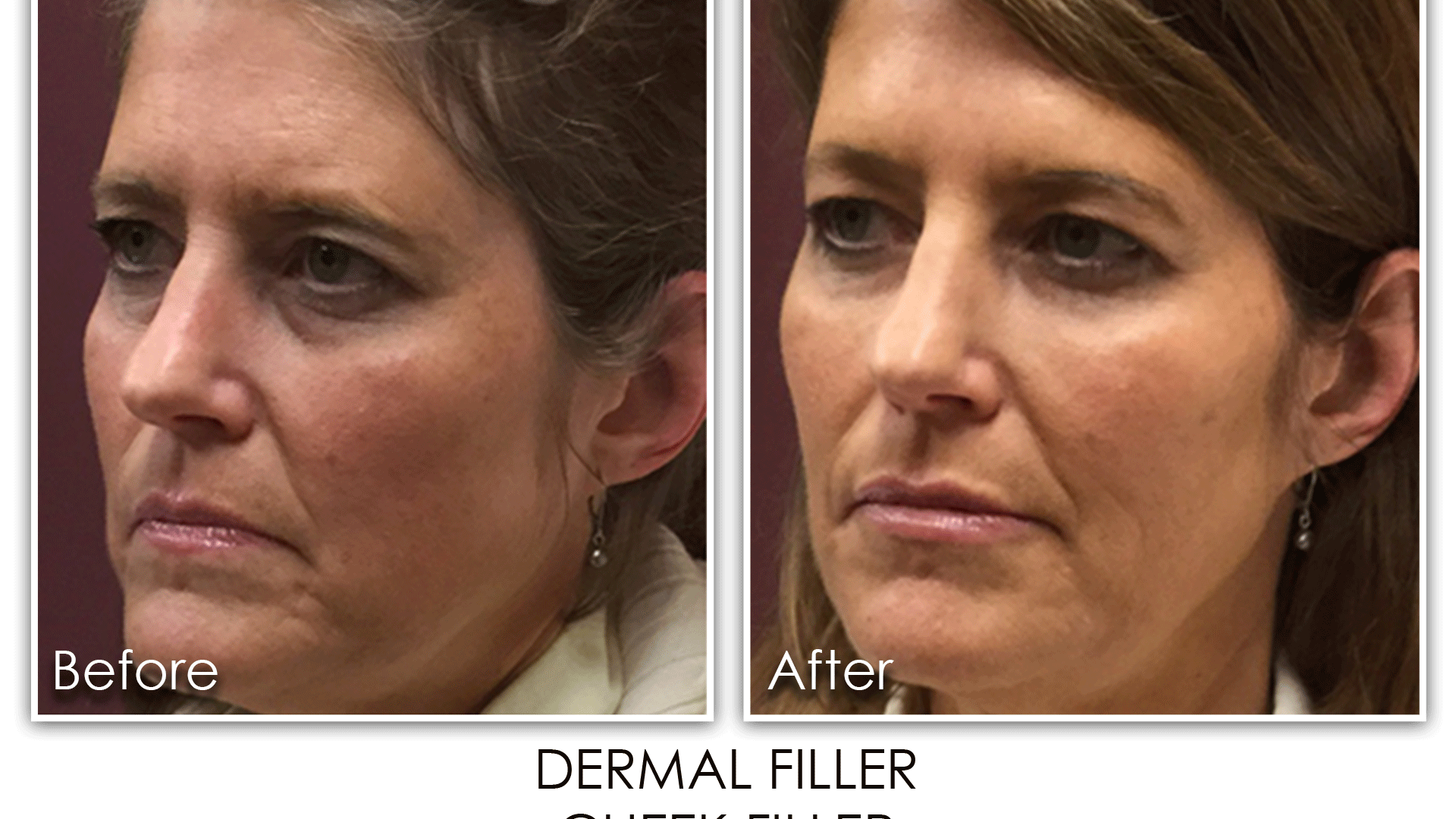 20 DERMAL FILLER CHEEK FILLER - Skin Rejuvenation Clinic Skin ...