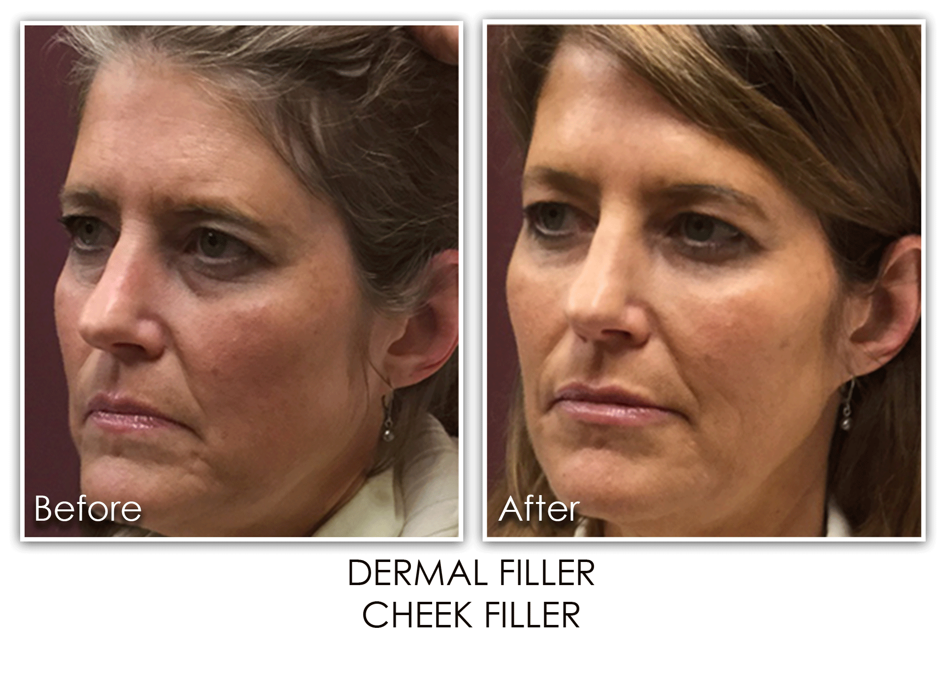 20 DERMAL FILLER CHEEK FILLER - Skin Rejuvenation Clinic Skin ...