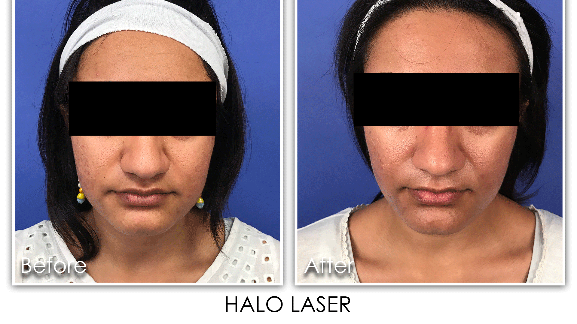 20 HALO - Skin Rejuvenation Clinic Skin Rejuvenation Clinic 20 HALO - Skin Rejuvenation Clinic Skin Rejuvenation Clinic