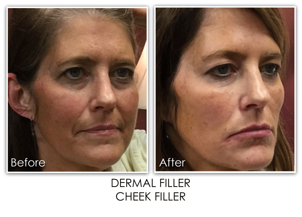 Cheek Filler Archives - Skin Rejuvenation Clinic Skin Rejuvenation Clinic