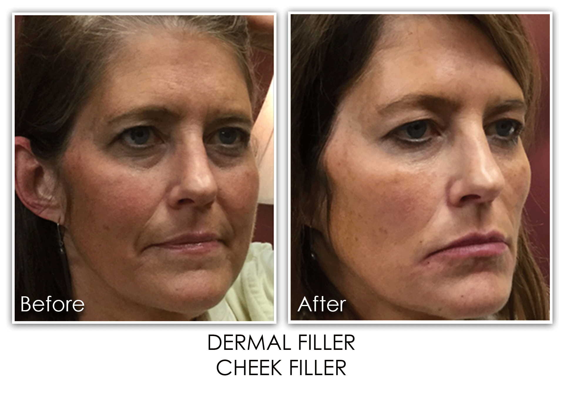 21 DERMAL FILLER CHEEK FILLER - Skin Rejuvenation Clinic Skin ...