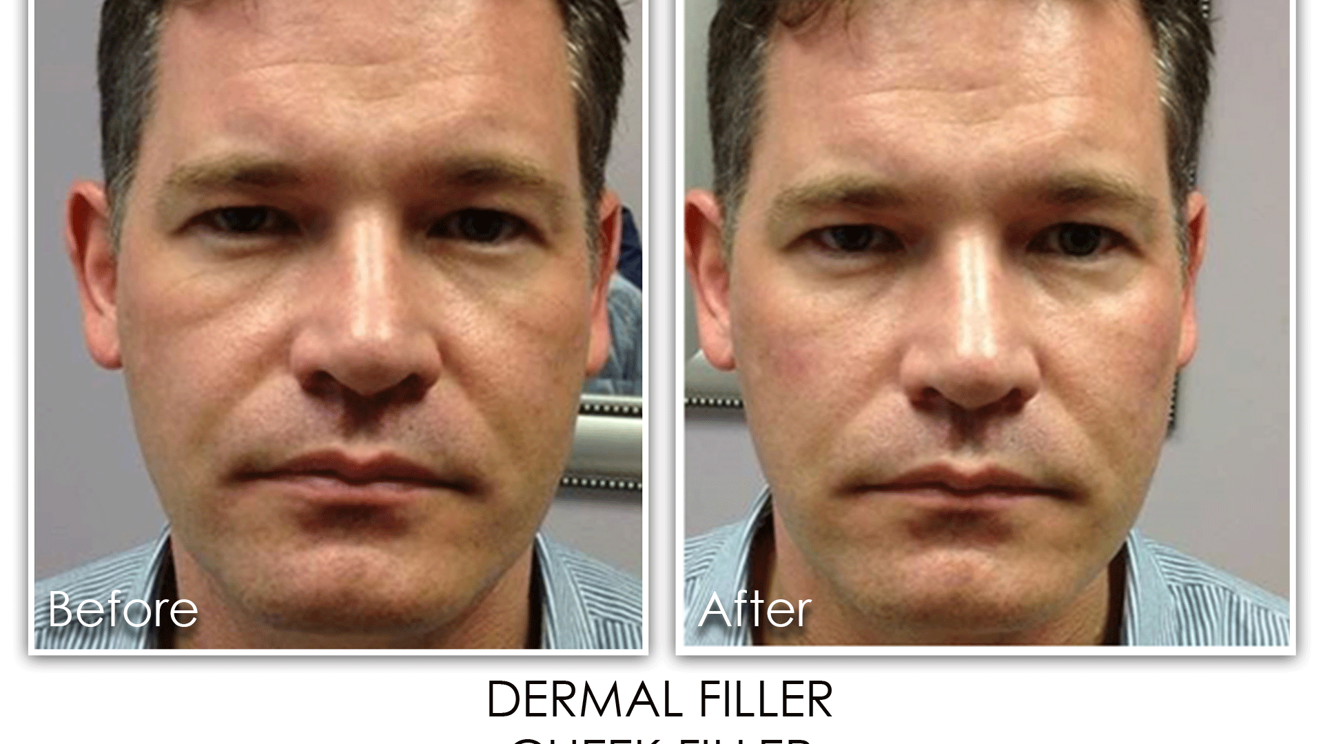 22 DERMAL FILLER CHEEK FILLER - Skin Rejuvenation Clinic Skin ...