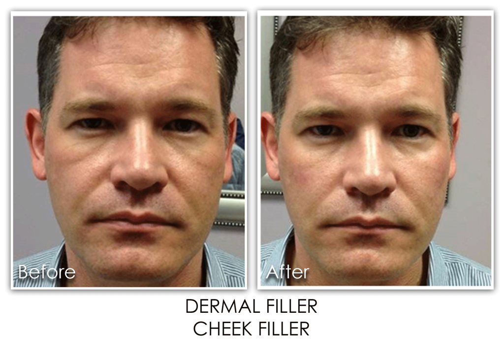 Cheek Fillers for Men Archives - Skin Rejuvenation Clinic Skin ...