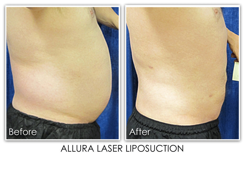 Allura Prolipo Laser Liposuction Archives - Page 3 of 5 | Skin ...
