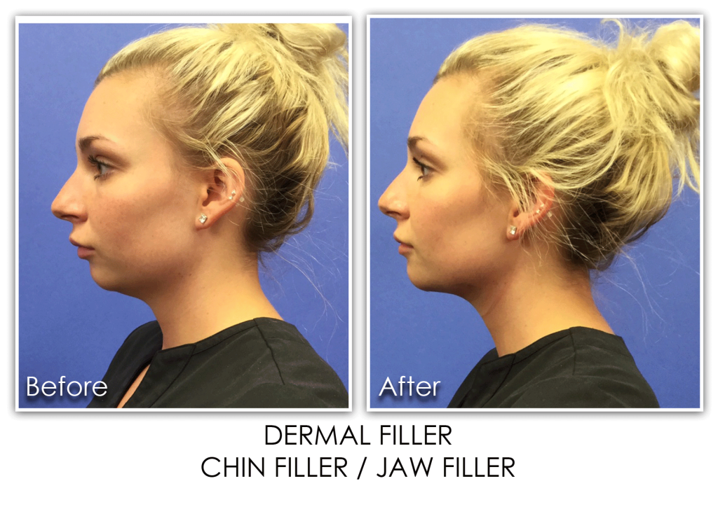 Chin Filler Archives Skin Rejuvenation Clinic Skin Rejuvenation Clinic