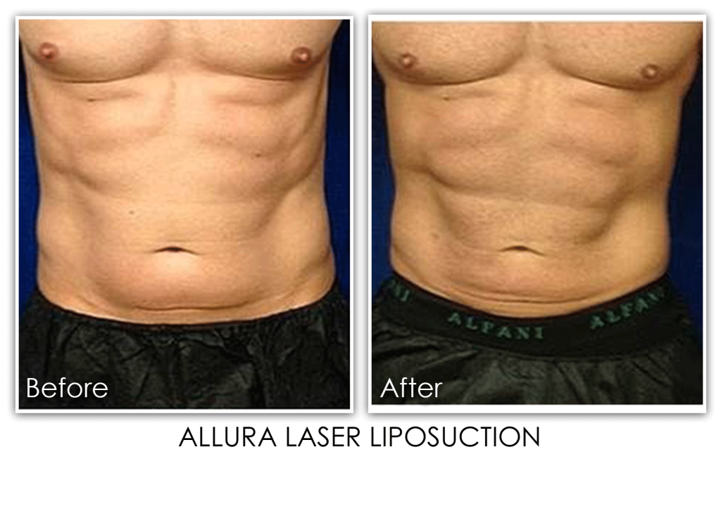 Allura Prolipo Laser Liposuction Archives - Page 3 of 5 - Skin ...