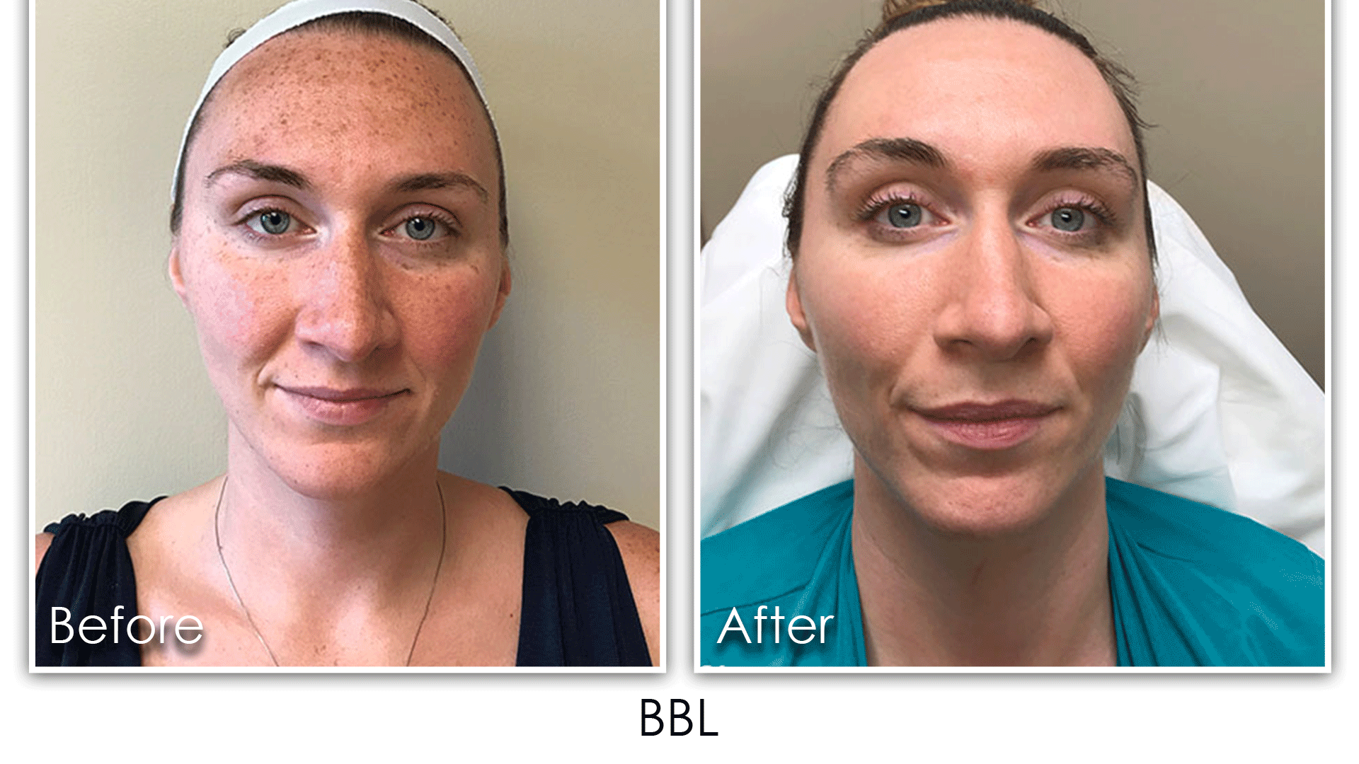 1 BBL - Skin Rejuvenation Clinic Skin Rejuvenation Clinic