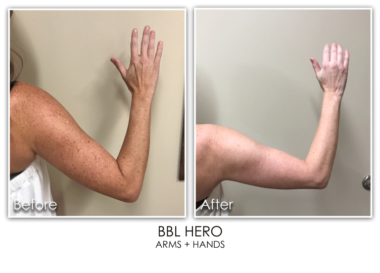 BBL Hero | BBL | Skin Rejuvenation Clinic Skin Rejuvenation Clinic