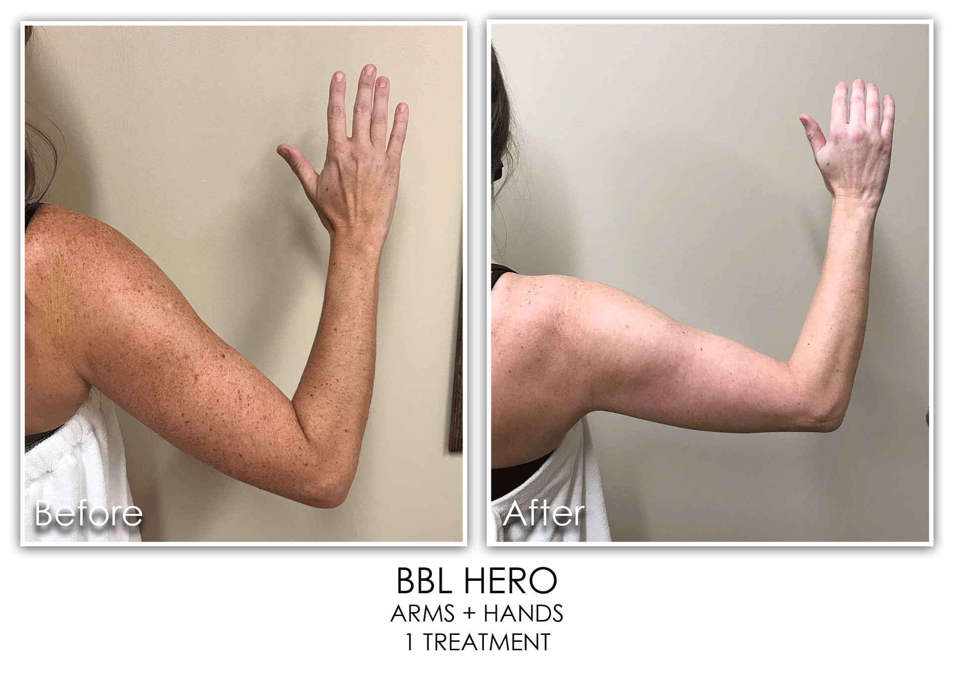 3 BBL HERO - Skin Rejuvenation Clinic Skin Rejuvenation Clinic