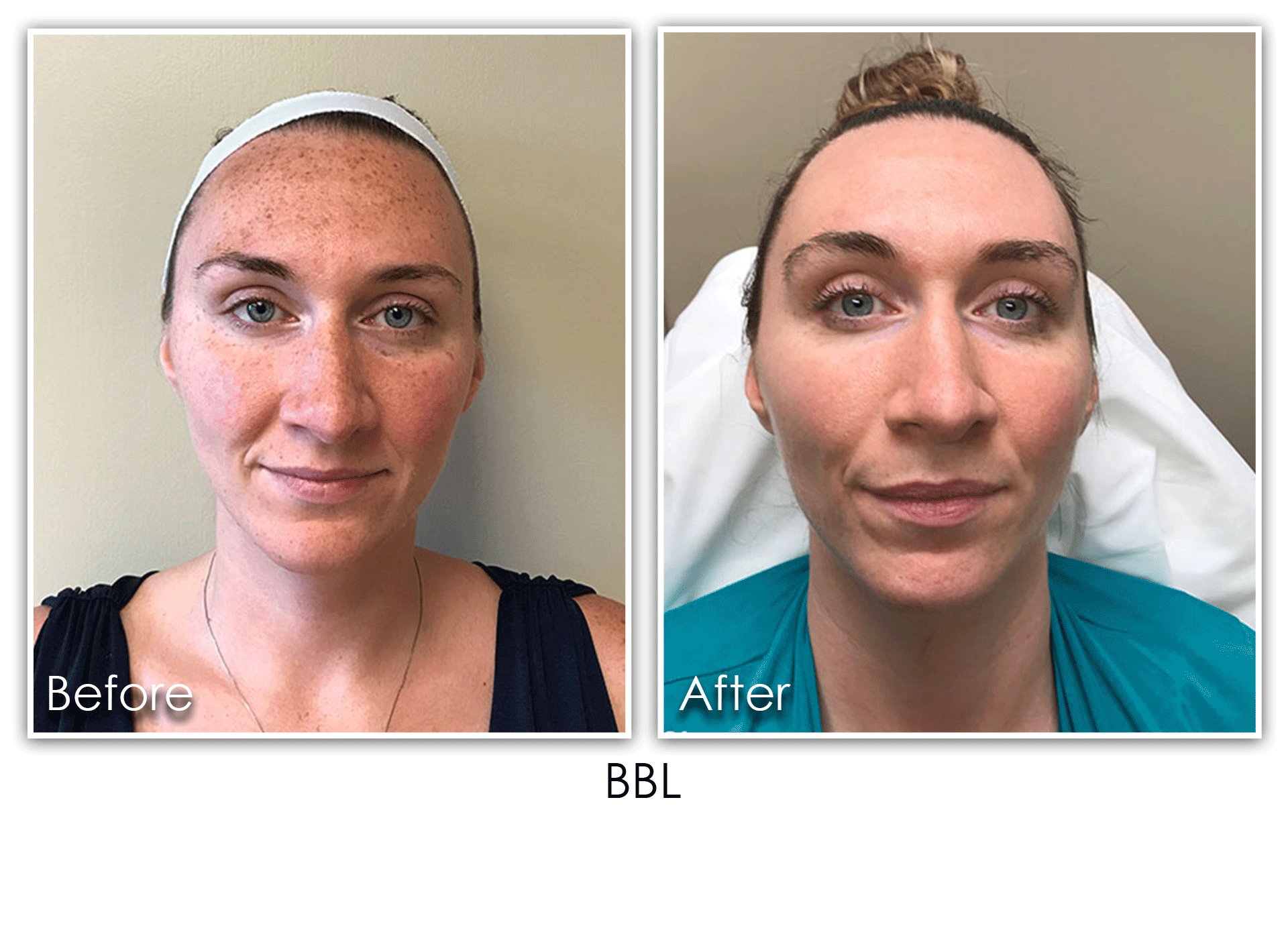 1 BBL - Skin Rejuvenation Clinic Skin Rejuvenation Clinic